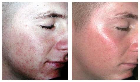 Candela Smoothbeem Laser - Upland Laser Dermatology
