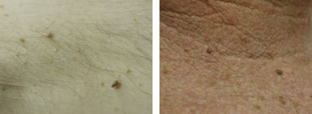 Acrochordons(Skin Tag Removal)