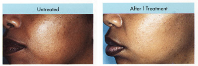 B-LIFT( Beta Lift) - Upland Laser Dermatology